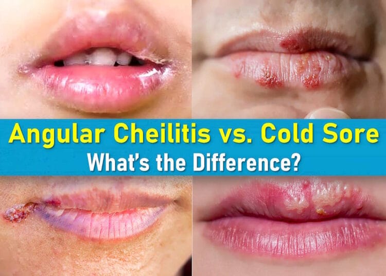 Sores at the Corner of Your Mouth: Angular Cheilitis or Cold Sore?